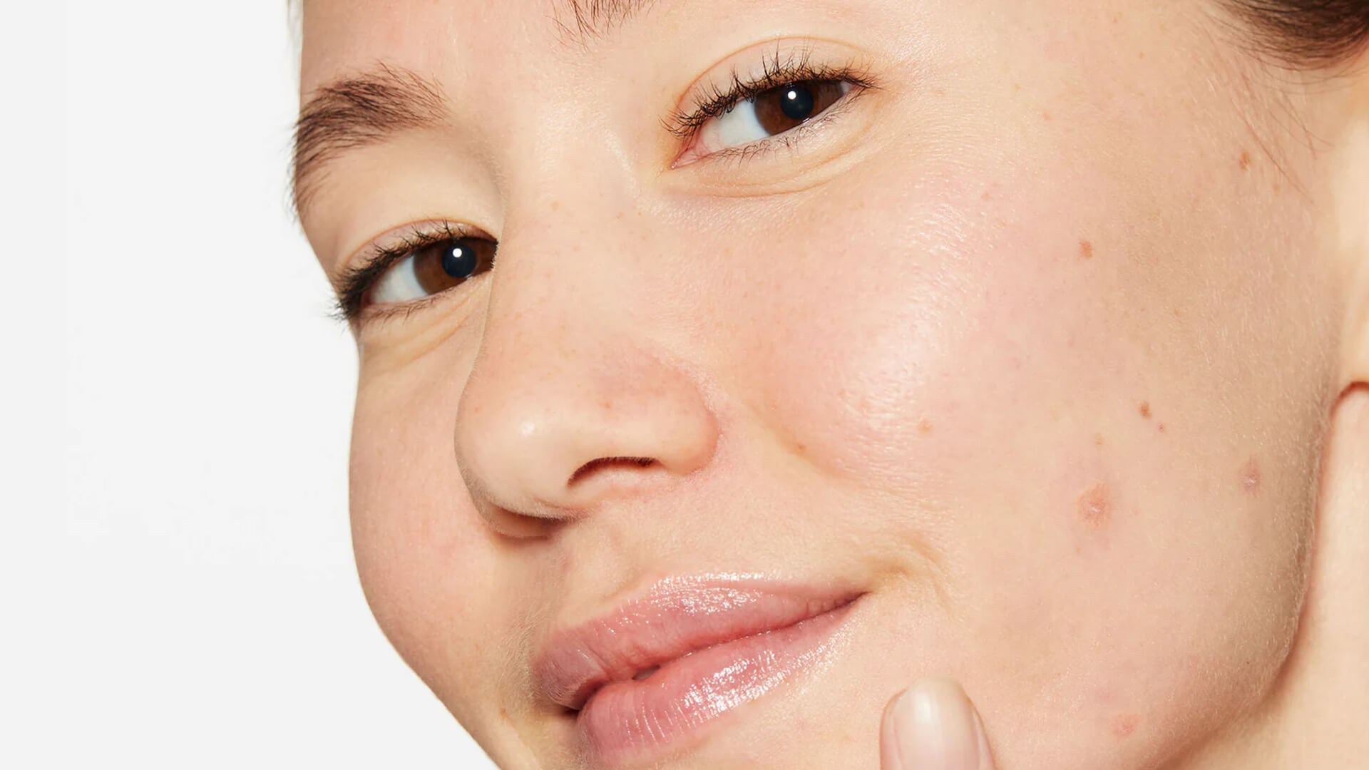 Types Of Spots And How To Treat Them