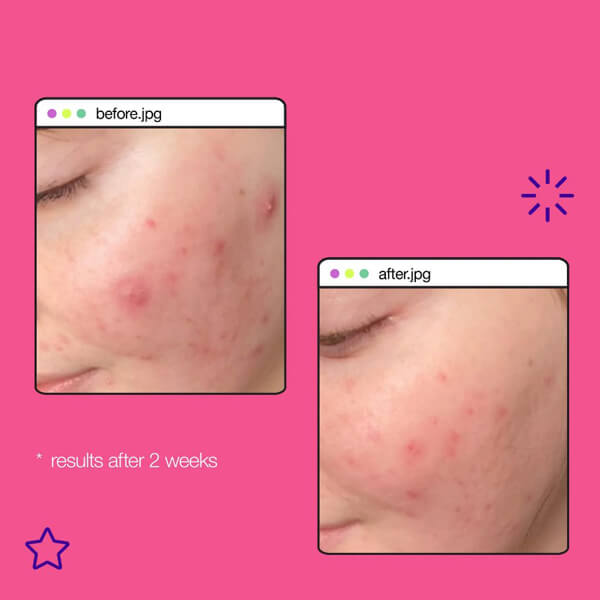 Dermalogica Breakout Clearing Liquid Peel | dPharmacy
